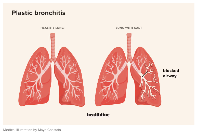 Plastic Bronchitis: Everything You Should Know - MD Spiro